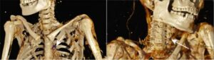 Surprise: Ancient Inuit Mummy Scans Reveal Possible Heart Disease ...