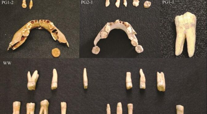 Tooth decay was a major problem for our ancestors 9,000 years ago ...