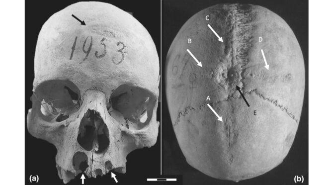 Signs of Surgery Examined on Medieval Woman’s Skull | ARCHAEOLOGY WORLD
