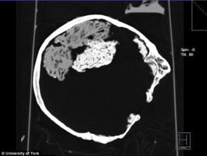 Scientists Discover Beheaded Man’s Brain Self-Preserved For 2,600 Years ...